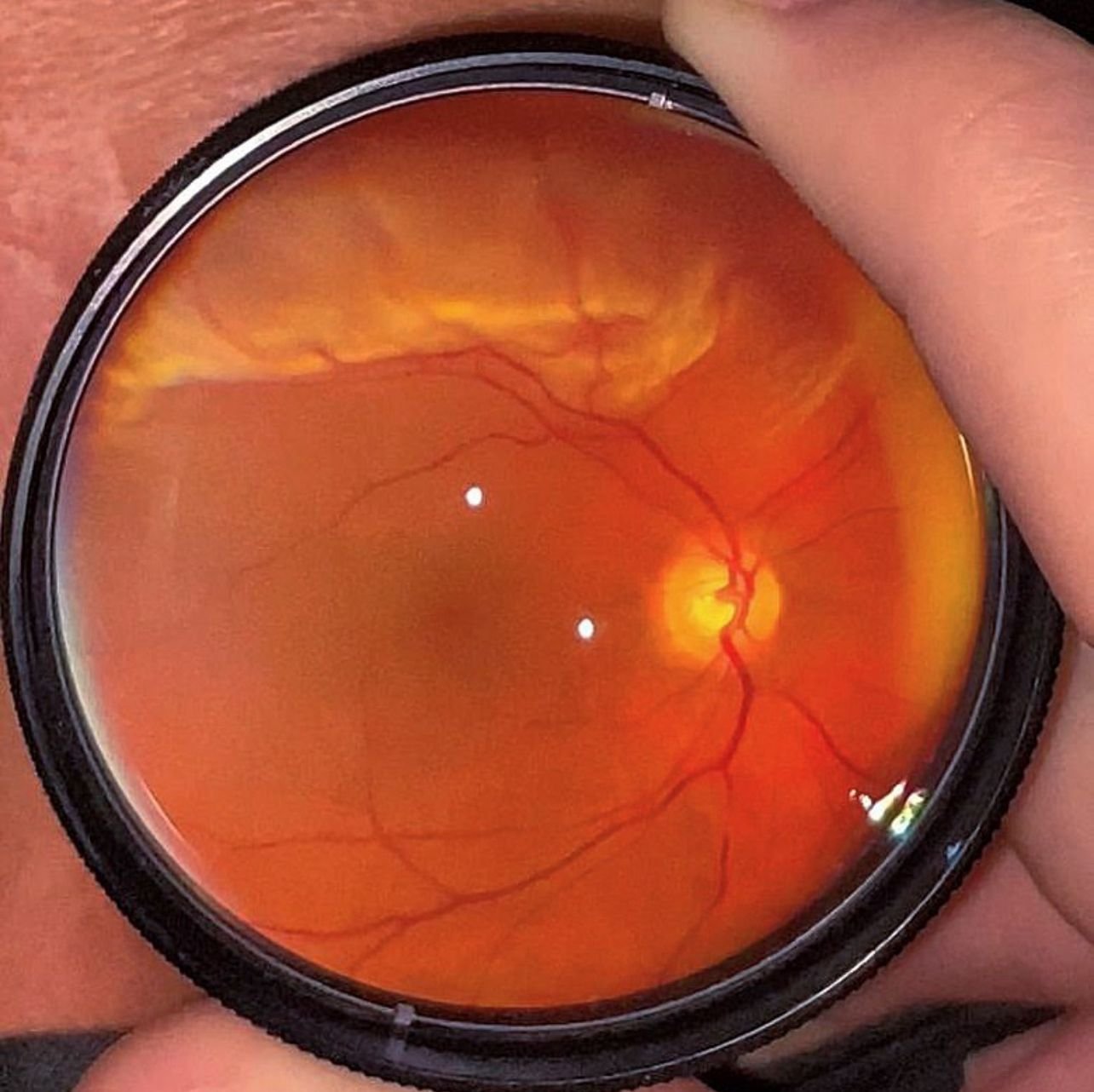 Descolamento de Retina: Entenda e Cuide da sua Visão - Centro Oftalmológico de Hortolândia ...